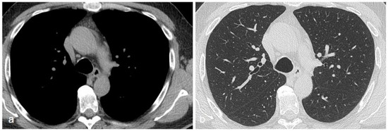 Thymic Hyperplasia and COVID-19 Pulmonary Sequelae: A Bicentric CT ...