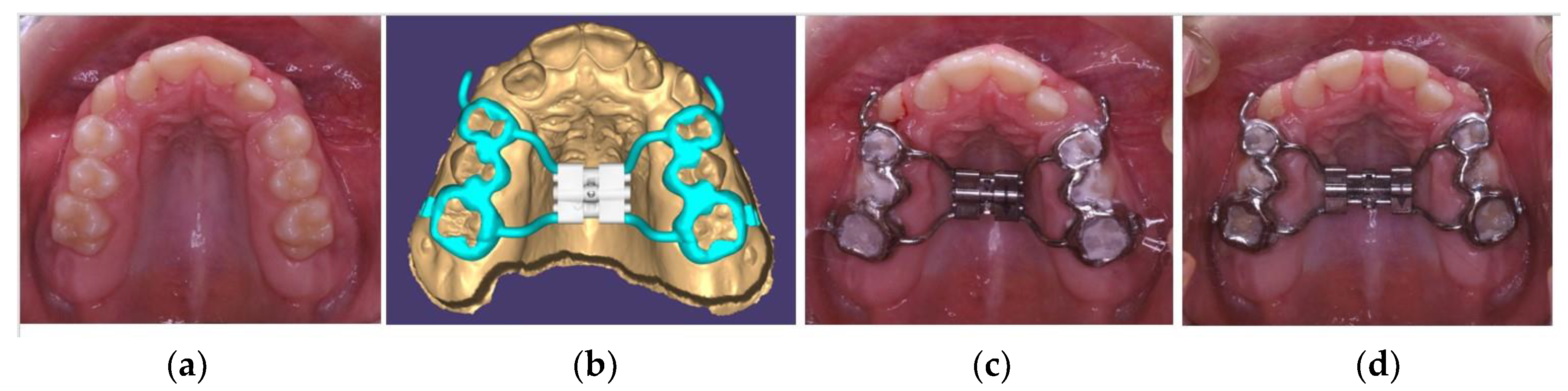 Change in Dental Arch Parameters—Perimeter, Width and Length after ...