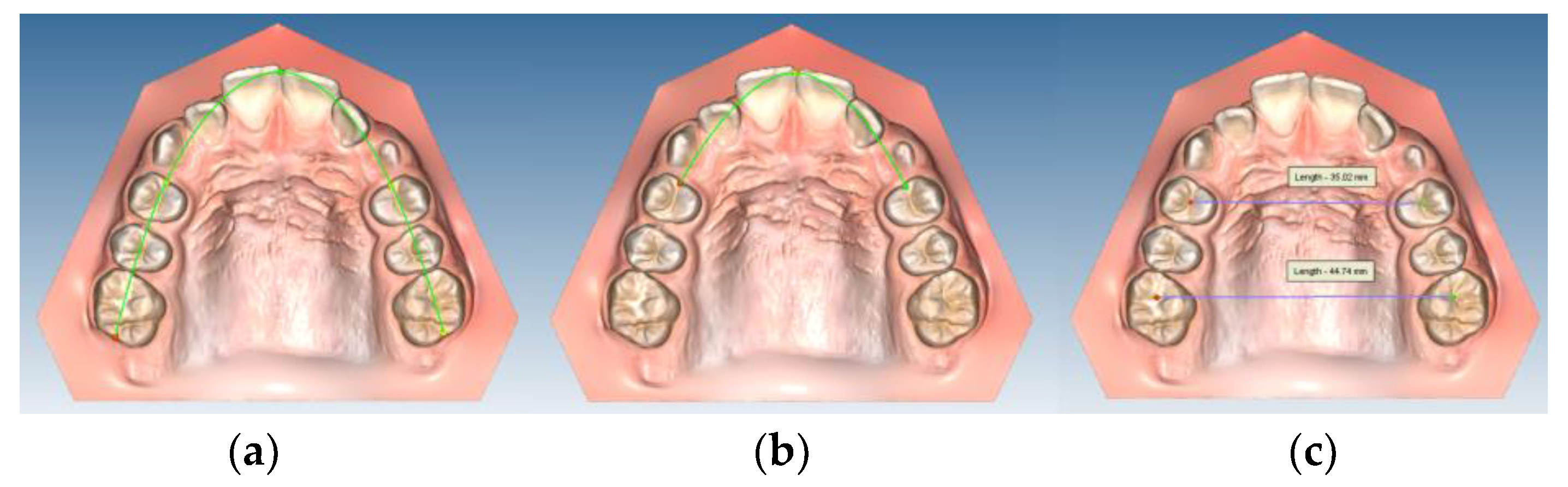 Change in Dental Arch Parameters—Perimeter, Width and Length after ...