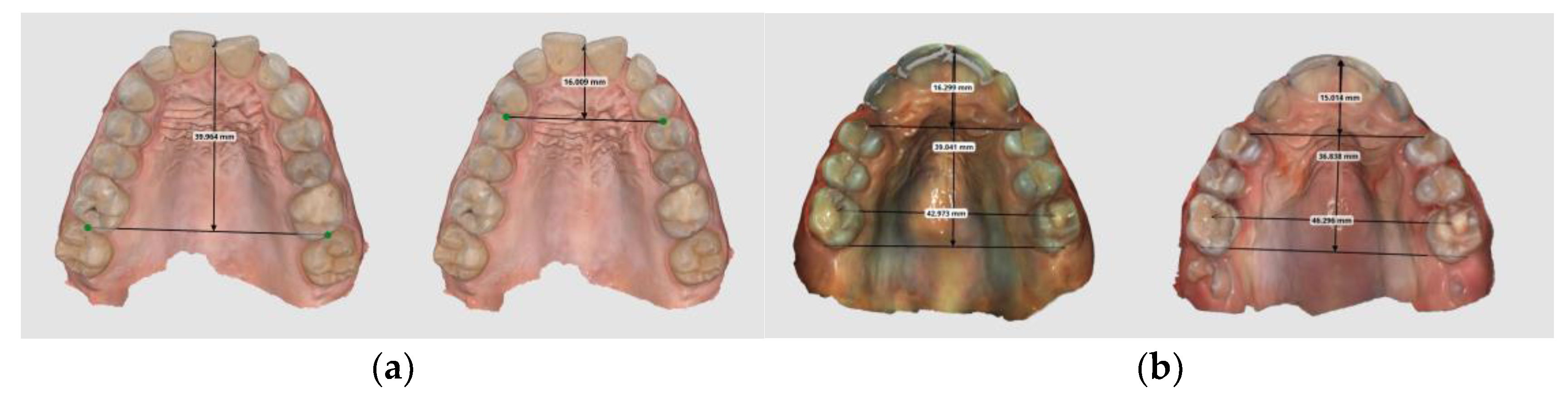 Change in Dental Arch Parameters—Perimeter, Width and Length after ...