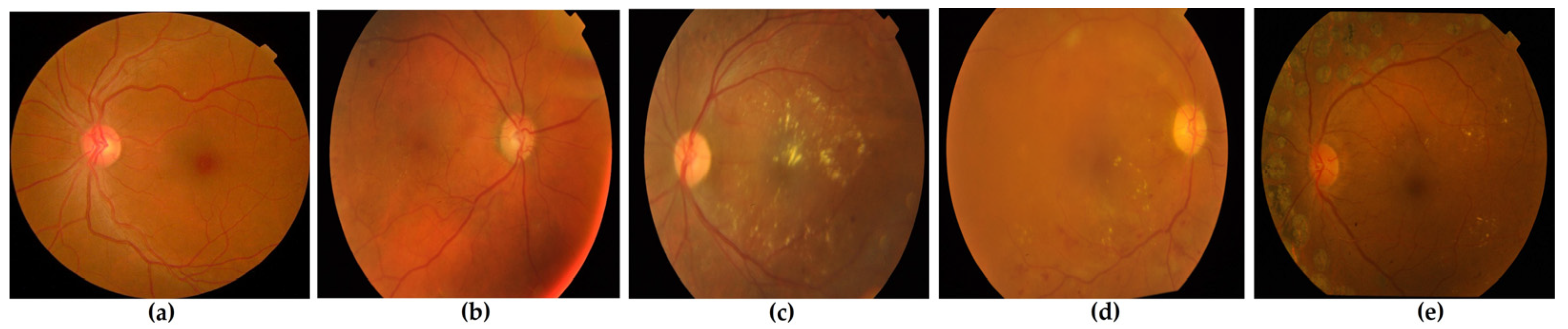 A Deep Learning Model for Detecting Diabetic Retinopathy Stages with ...