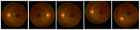 A Deep Learning Model for Detecting Diabetic Retinopathy Stages with ...