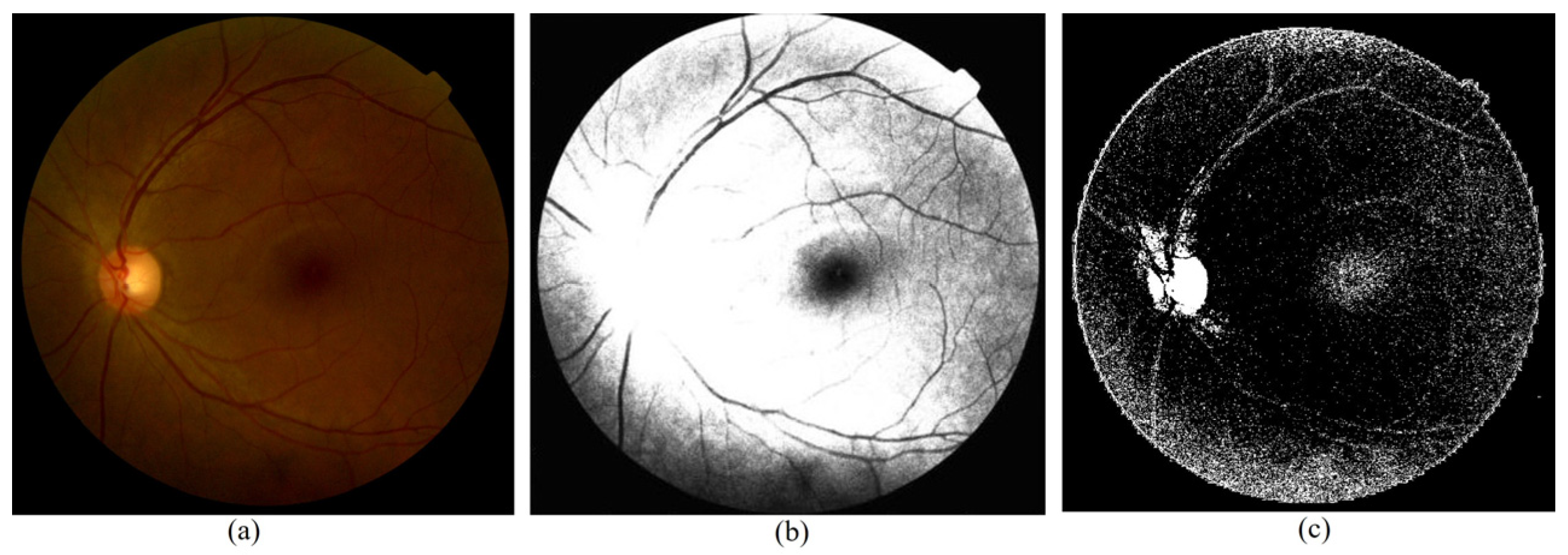 A Deep Learning Model for Detecting Diabetic Retinopathy Stages with ...