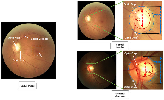 Precision Diagnosis of Glaucoma with VLLM Ensemble Deep Learning