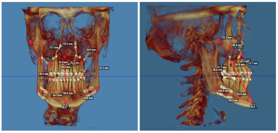 Imaging and 3D Analysis Based on Two or More Three-Dimensional CBCT ...