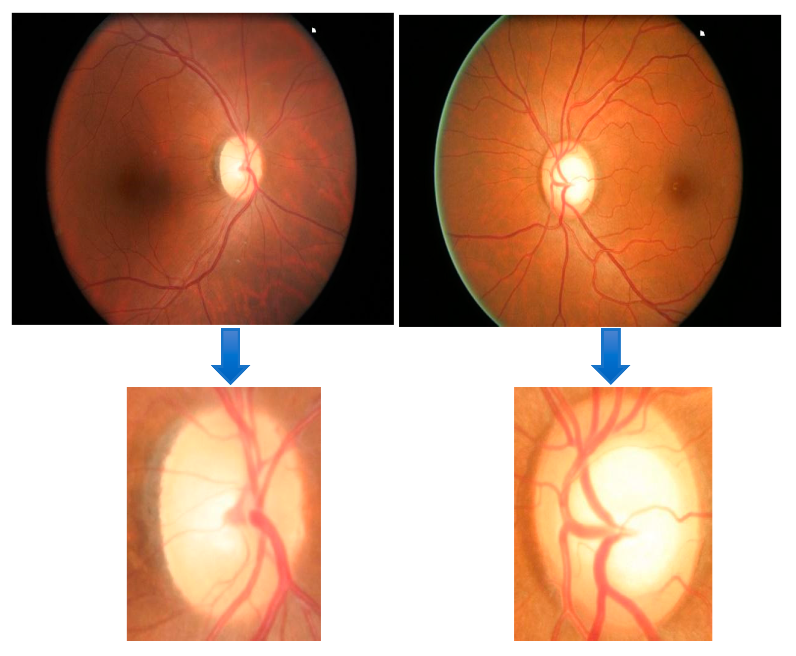 Optic Disc Segmentation in Human Retina Images Using a Meta Heuristic ...