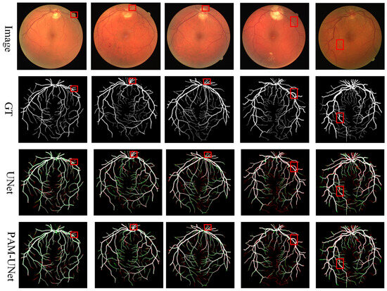 PAM-UNet: Enhanced Retinal Vessel Segmentation Using a Novel Plenary ...