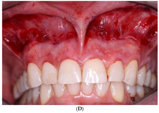 Modified Lip Repositioning Surgery in the Treatment of Gummy Smile