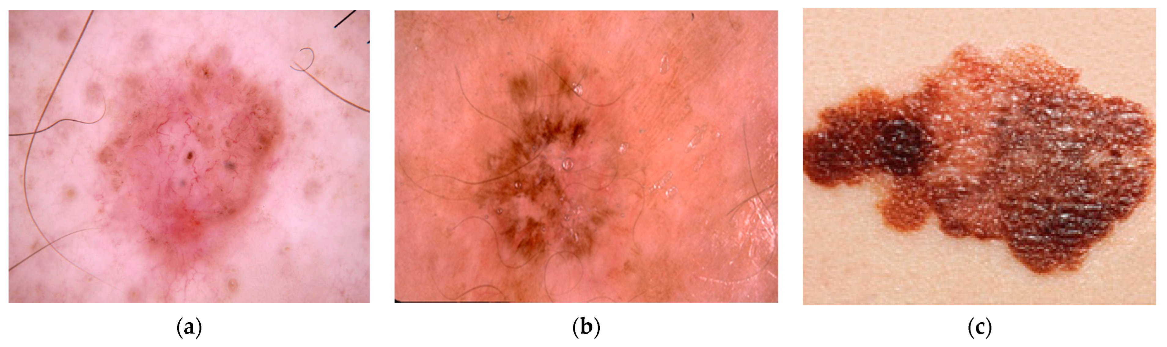 Applied Sciences | Free Full-Text | Skin Lesion Classification Using a Deep Ensemble Model