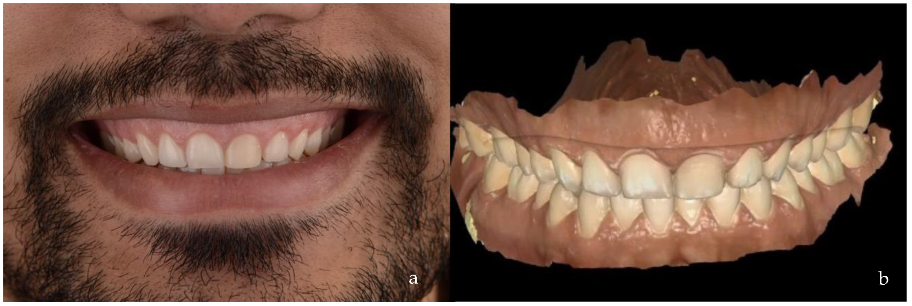 Full Digital Workflow for Aesthetic Rehabilitation of the Upper Teeth ...