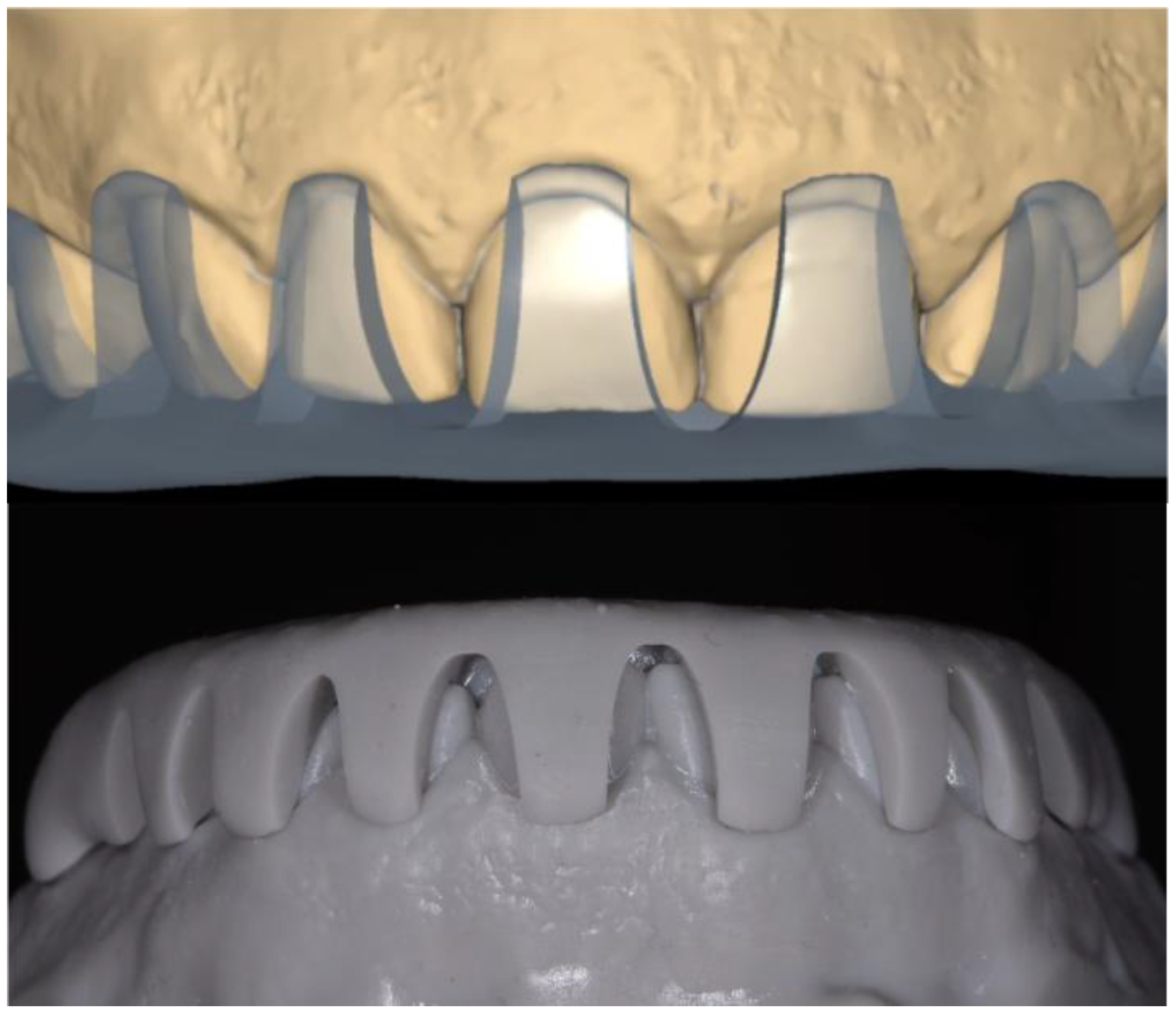 Full Digital Workflow for Aesthetic Rehabilitation of the Upper Teeth ...
