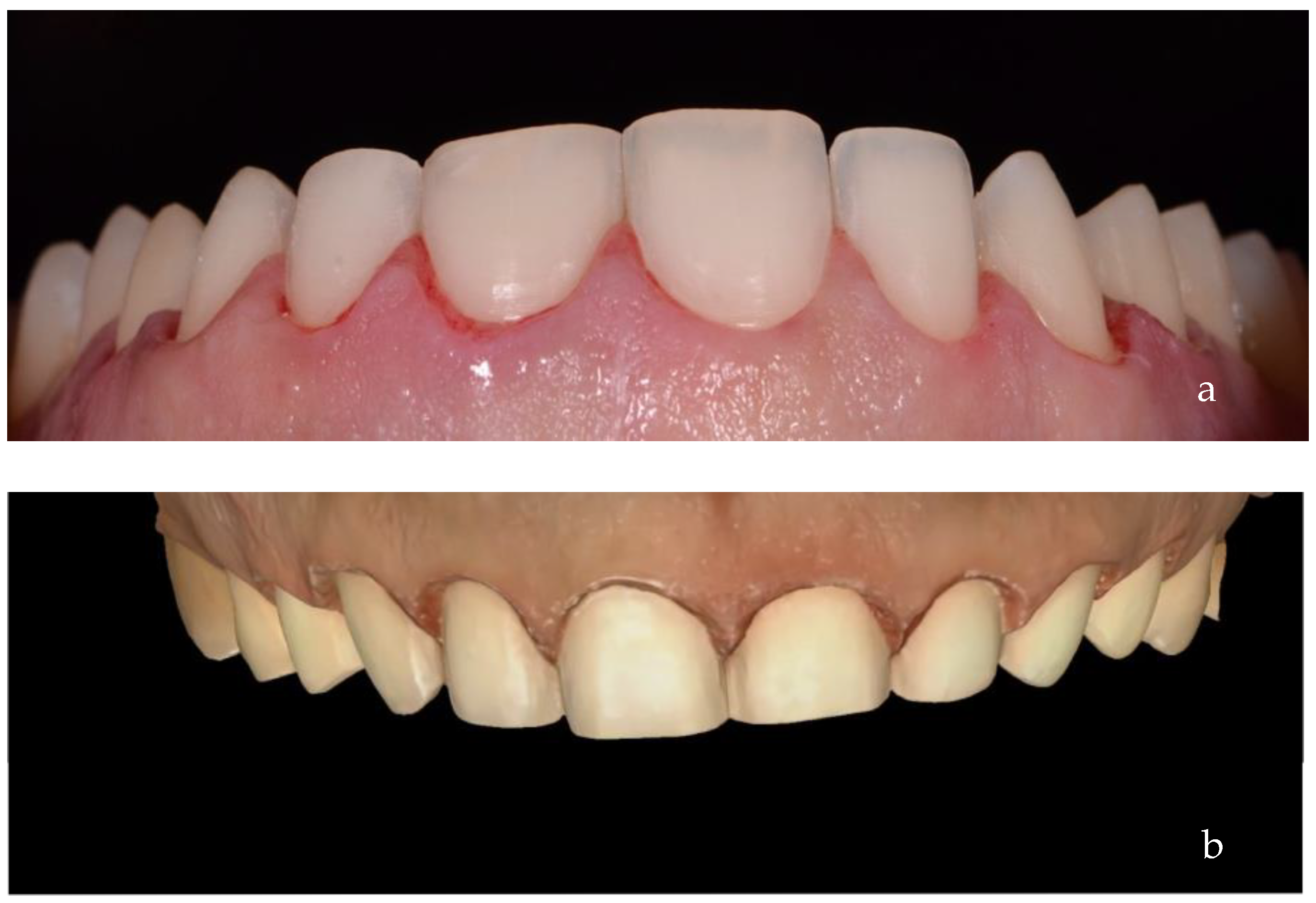 Full Digital Workflow for Aesthetic Rehabilitation of the Upper Teeth ...