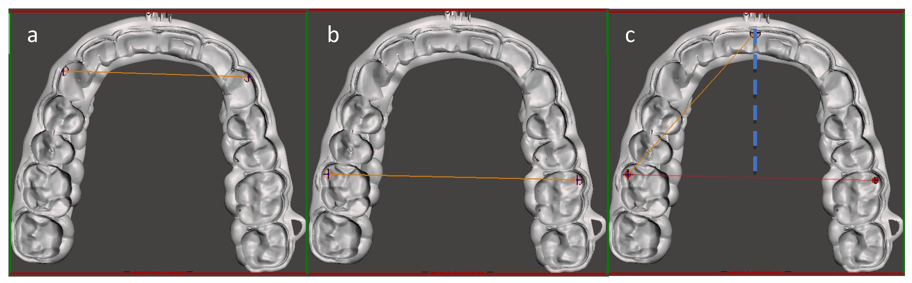 Accuracy and Precision of Three-Dimensionally Printed Orthognathic ...