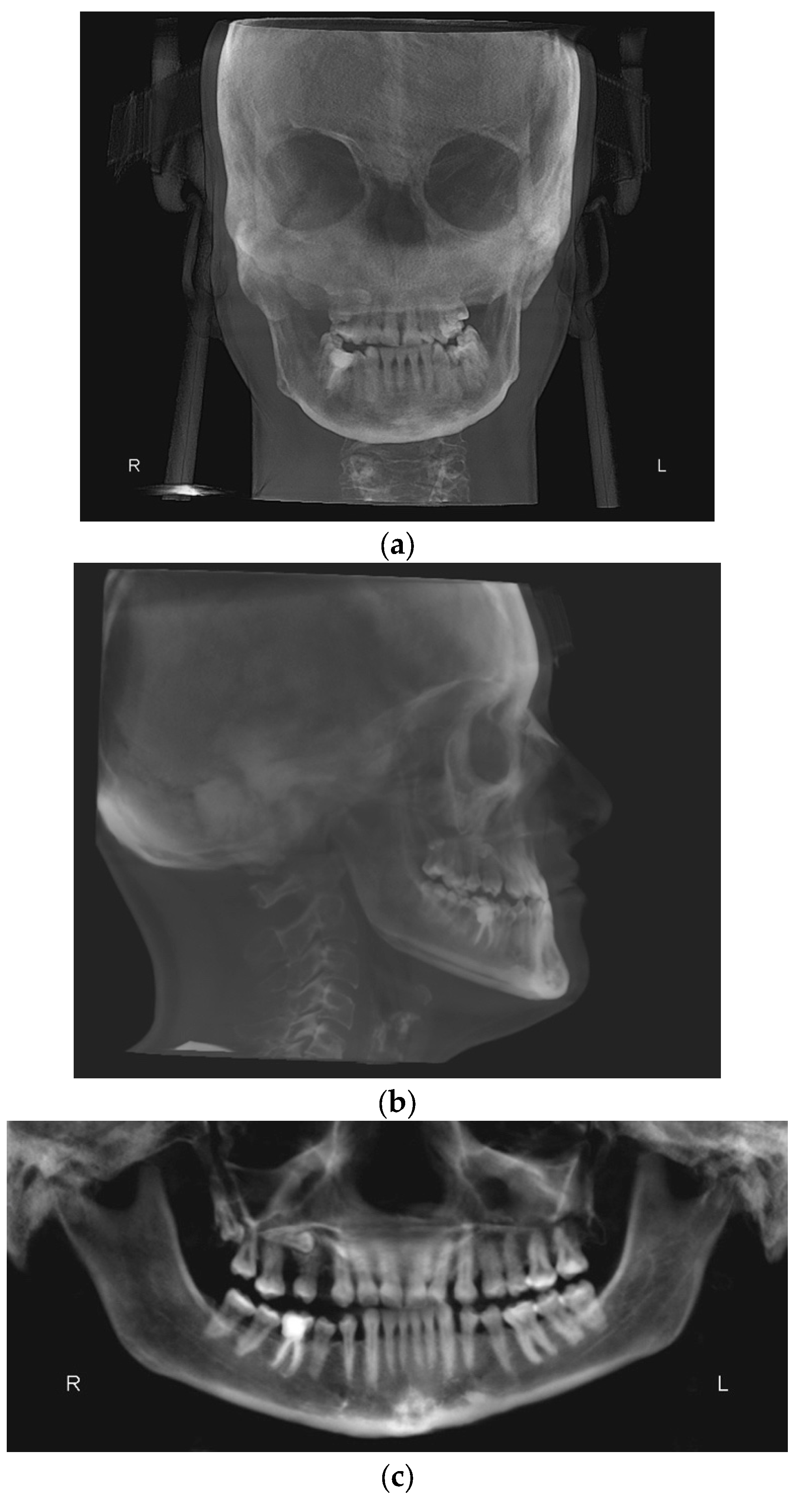 Treatment of Orthognathic Surgical Class III Patient with Coffin–Siris ...