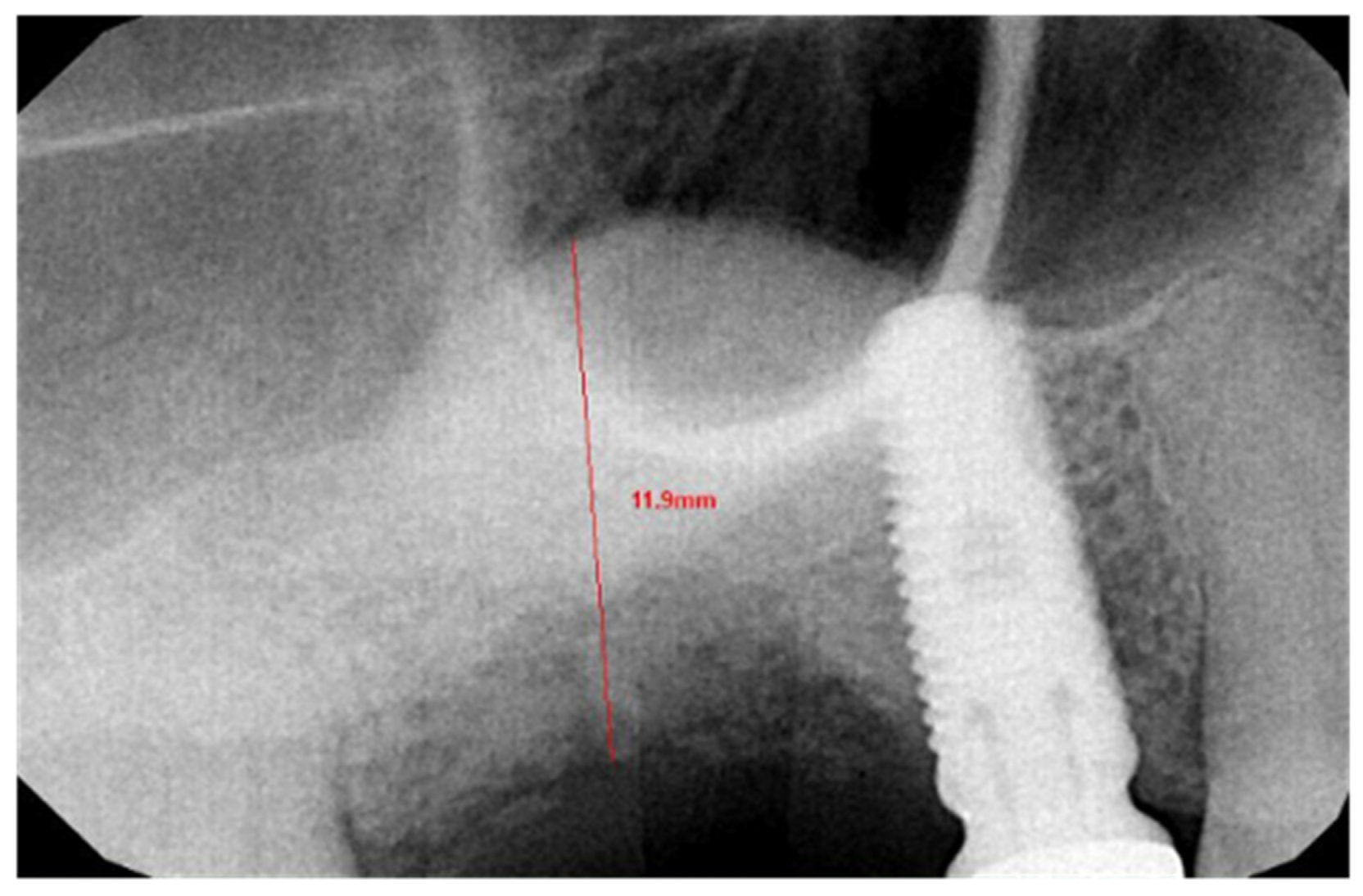 Crestal Sinus Lift with the Hydrodynamic Technique: Prospective ...