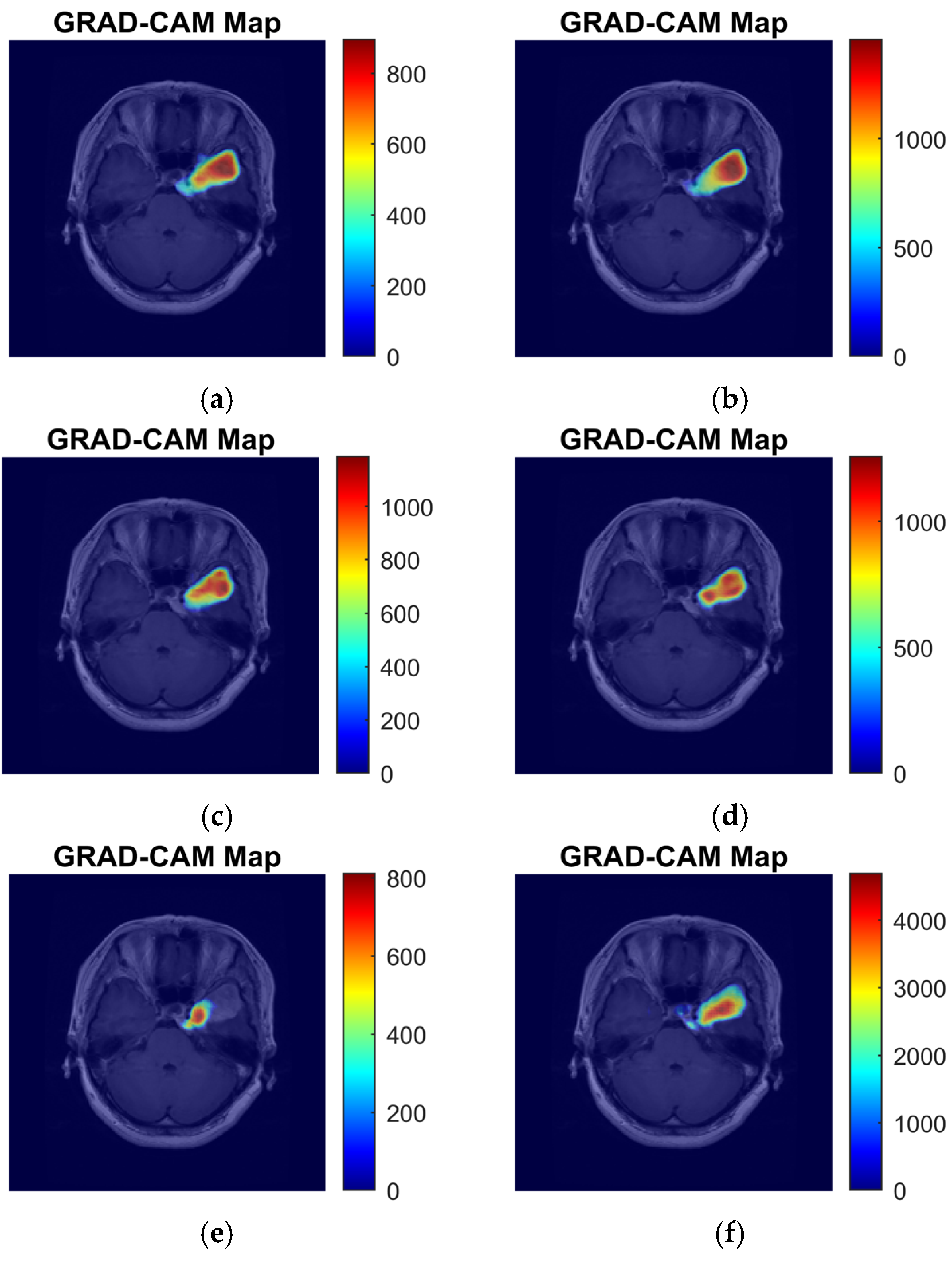 Improved Brain Tumor Segmentation in MR Images with a Modified U-Net