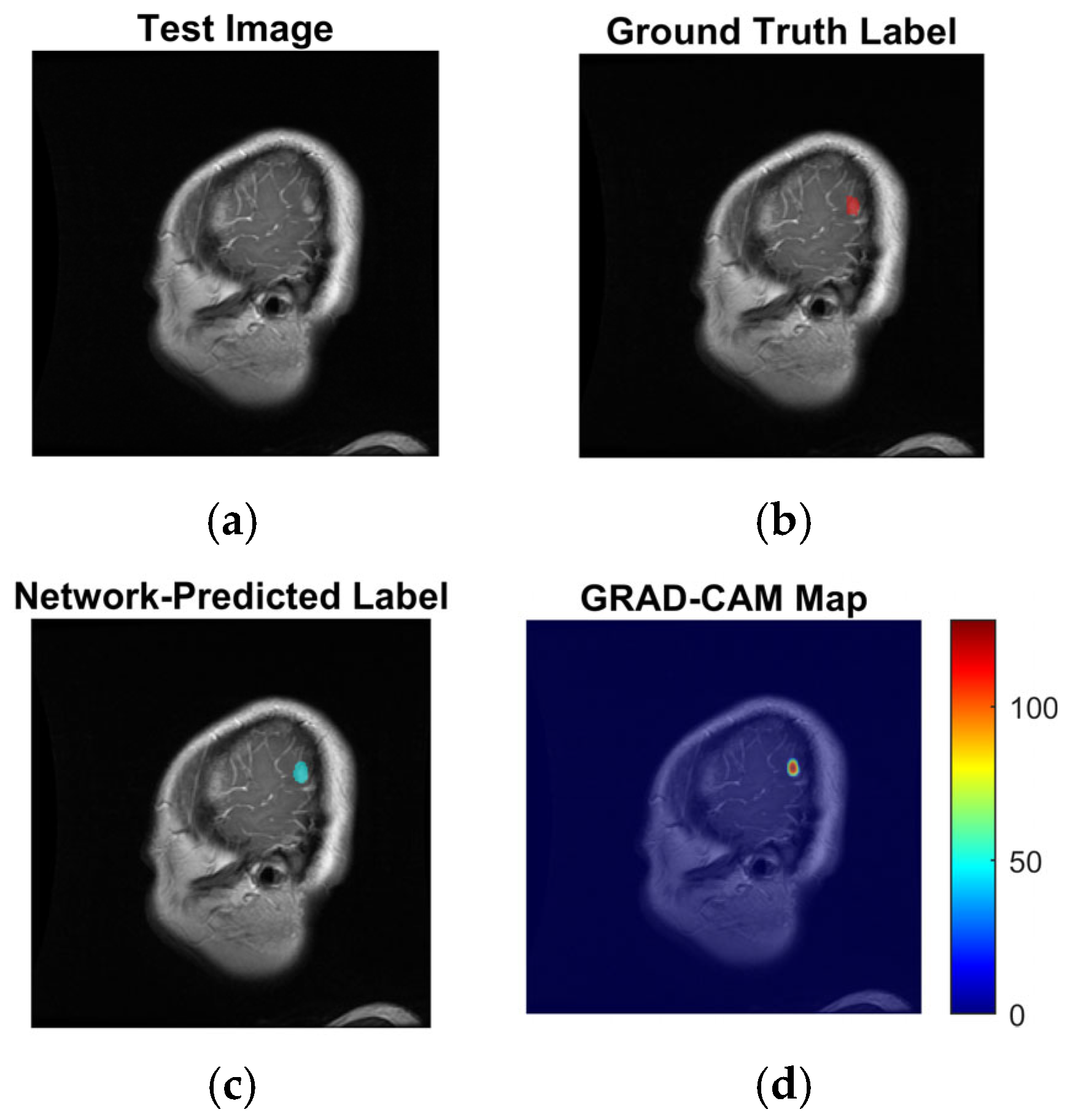 Improved Brain Tumor Segmentation in MR Images with a Modified U-Net