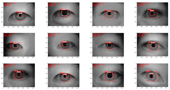 Research on Pupil Center Localization Detection Algorithm with Improved YOLOv8