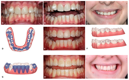Staging of Orthodontic Tooth Movement in Clear Aligner Treatment: Macro ...