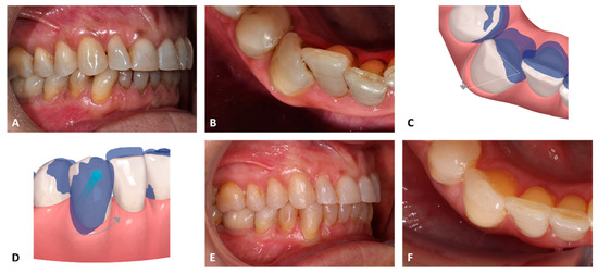 Staging of Orthodontic Tooth Movement in Clear Aligner Treatment: Macro ...