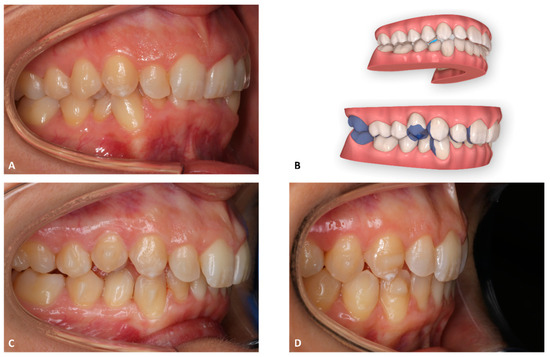Staging of Orthodontic Tooth Movement in Clear Aligner Treatment: Macro-Staging and Micro ...