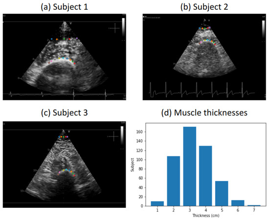 DeepSarc-US: A Deep Learning Framework for Assessing Sarcopenia Using Ultrasound Images