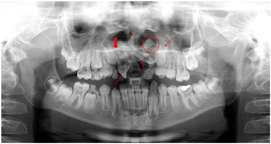 Types Of Cleft Palate Radiology Istantan - Infoupdate.org