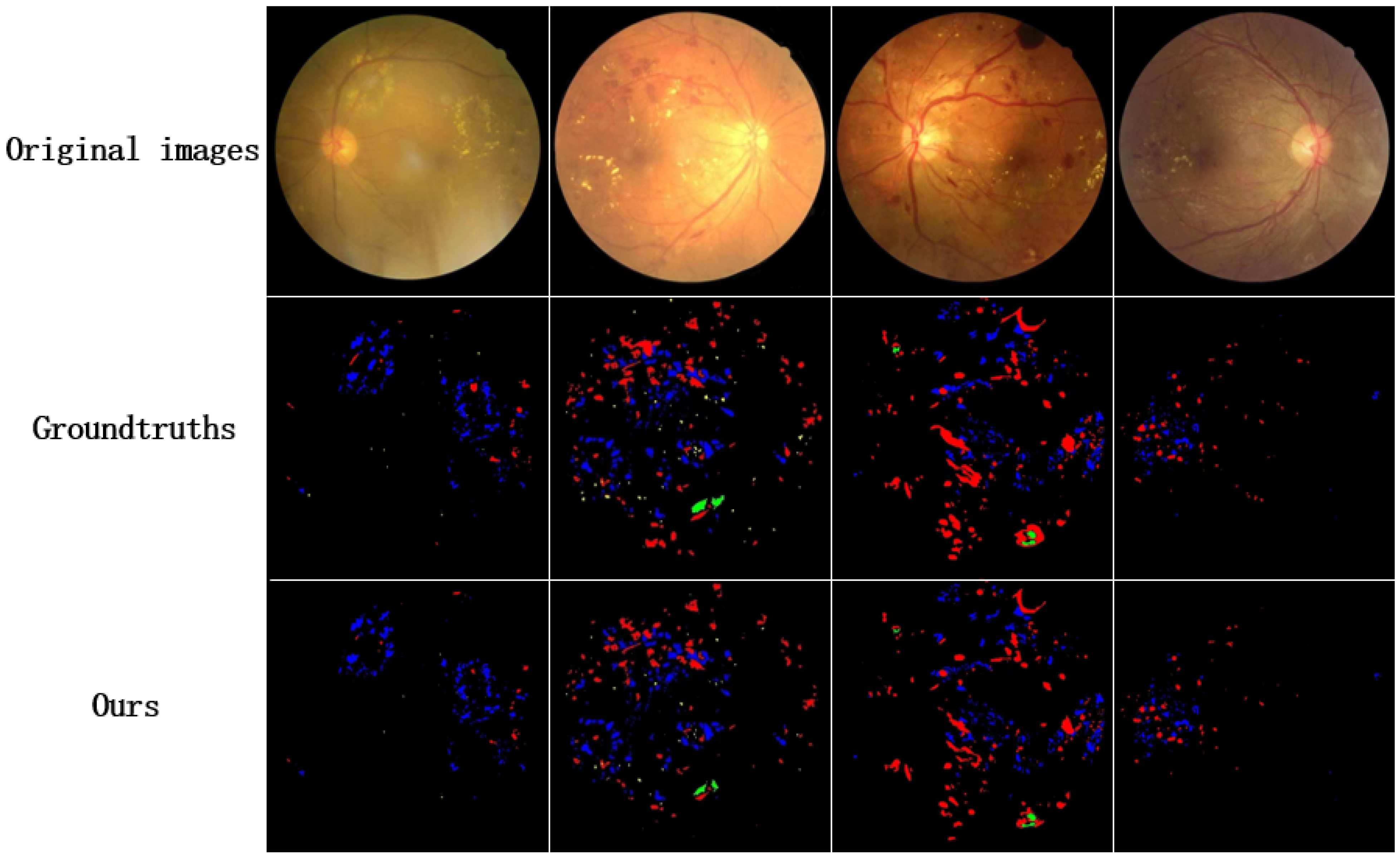 Lightweight Frequency Recalibration Network for Diabetic Retinopathy ... Lightweight Frequency Recalibration Network for Diabetic Retinopathy ...