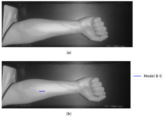 Forearm Intravenous Detection And Localization For Autonomous Vein Injection Using Contrast