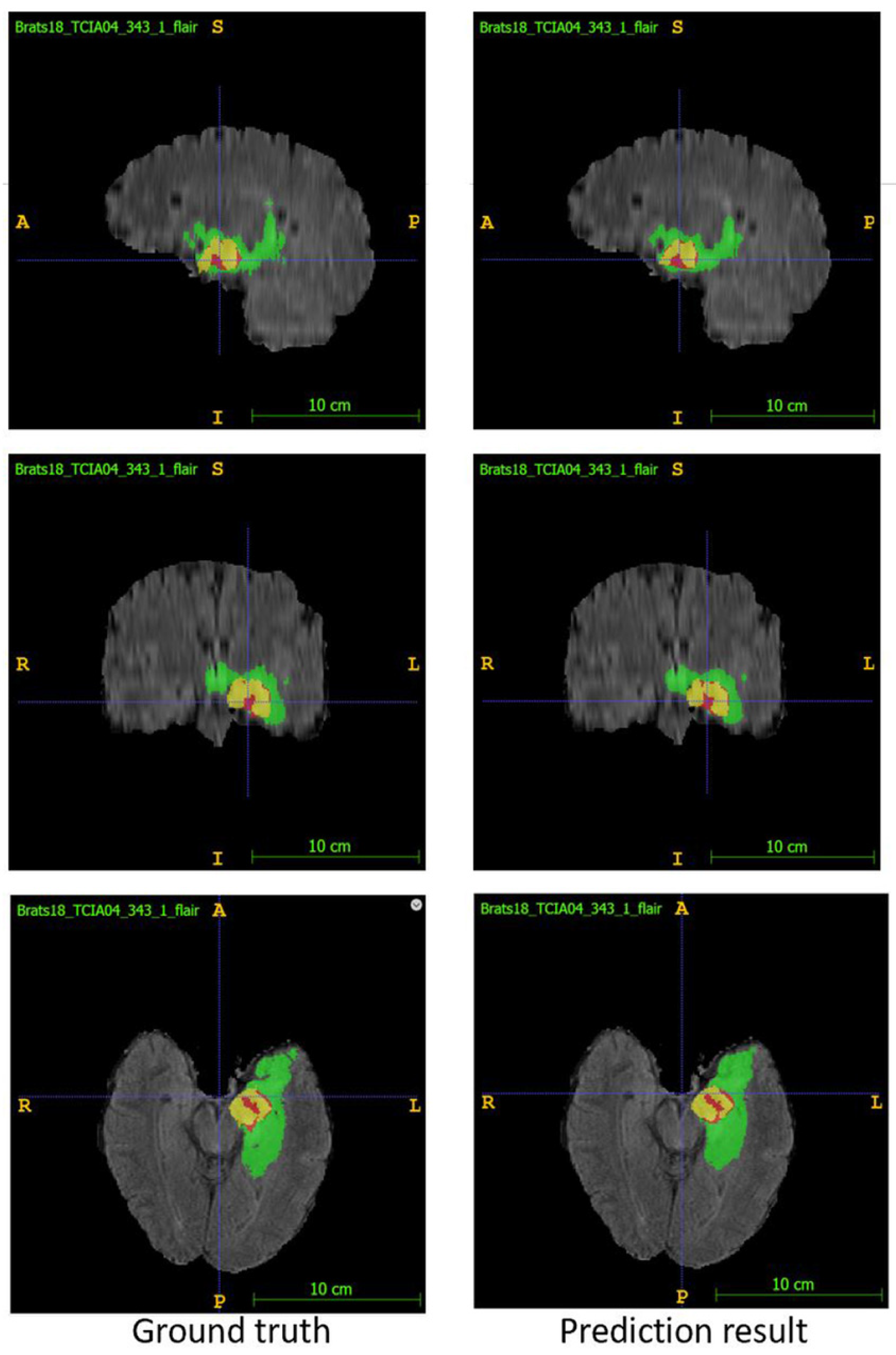 Accurate MRI-Based Brain Tumor Diagnosis: Integrating Segmentation and Deep Learning Approaches