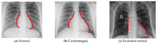 A Development and Validation of an AI Model for Cardiomegaly Detection ...