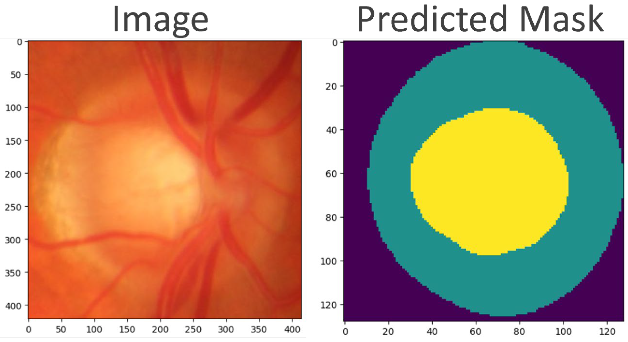 Optimizing Glaucoma Diagnosis with Deep Learning-Based Segmentation and Classification of ...
