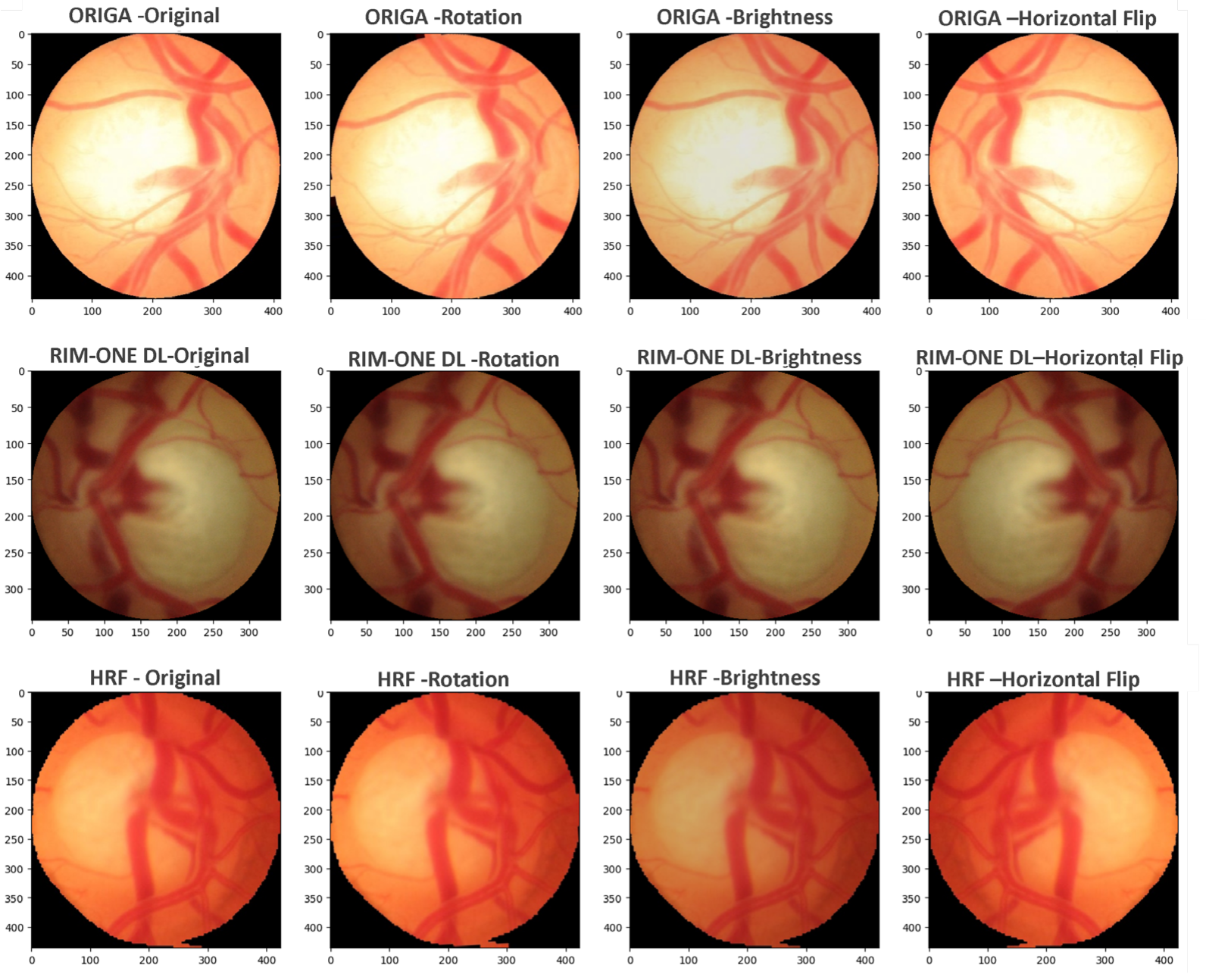 Optimizing Glaucoma Diagnosis with Deep Learning-Based Segmentation and Classification of ...