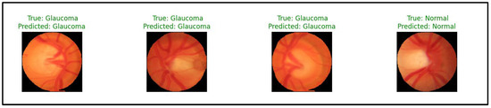 Optimizing Glaucoma Diagnosis with Deep Learning-Based Segmentation and Classification of ...