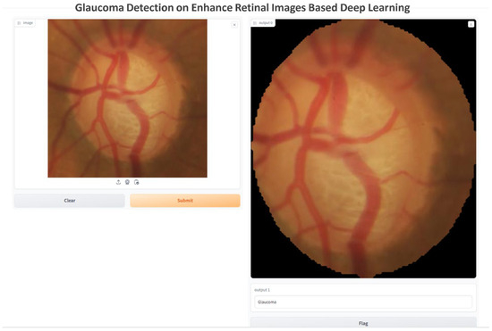 Optimizing Glaucoma Diagnosis with Deep Learning-Based Segmentation and Classification of ...