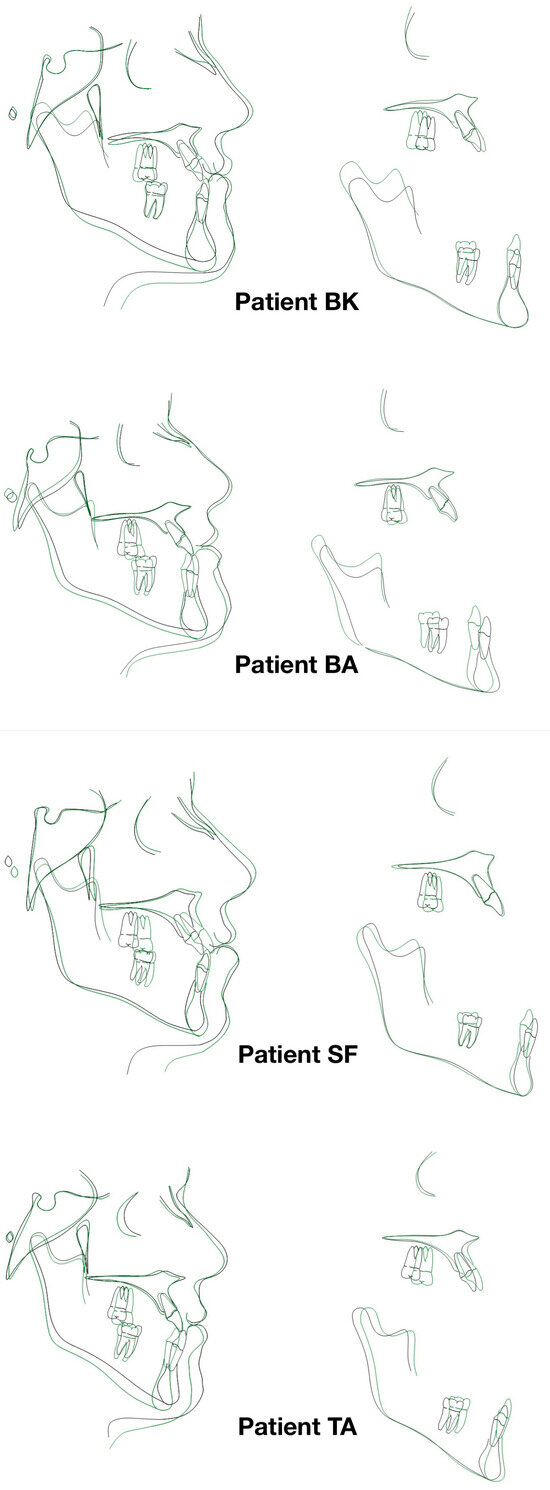 Three-Stage Non-Surgical Treatment of Skeletal Class III Malocclusion ...