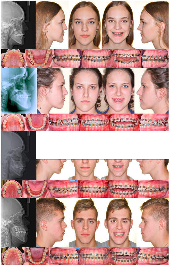 Three-Stage Non-Surgical Treatment of Skeletal Class III Malocclusion ...