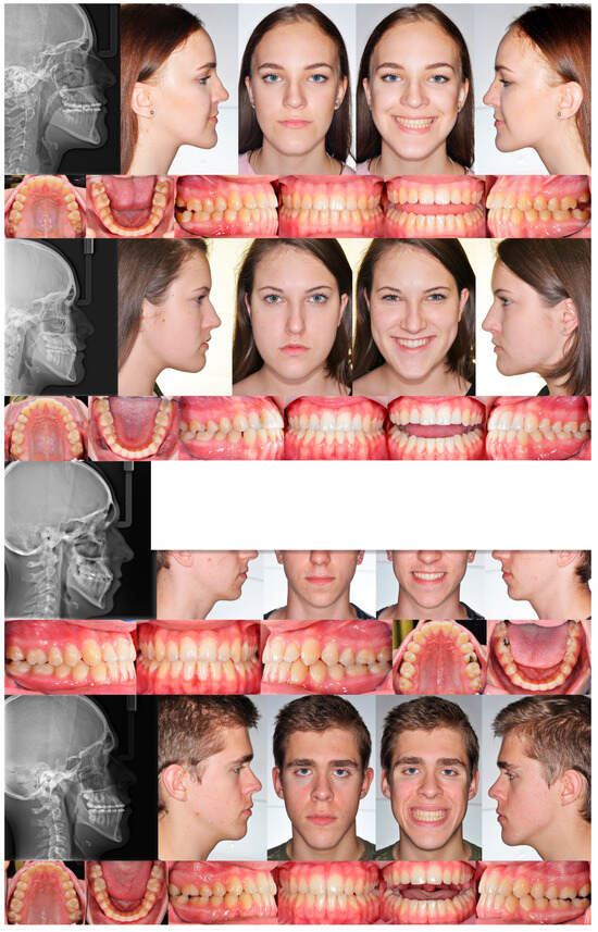 Three-Stage Non-Surgical Treatment of Skeletal Class III Malocclusion ...