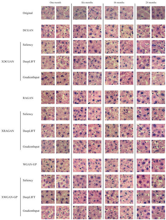 Data Augmentation in Histopathological Classification: An Analysis Exploring GANs with XAI and ...