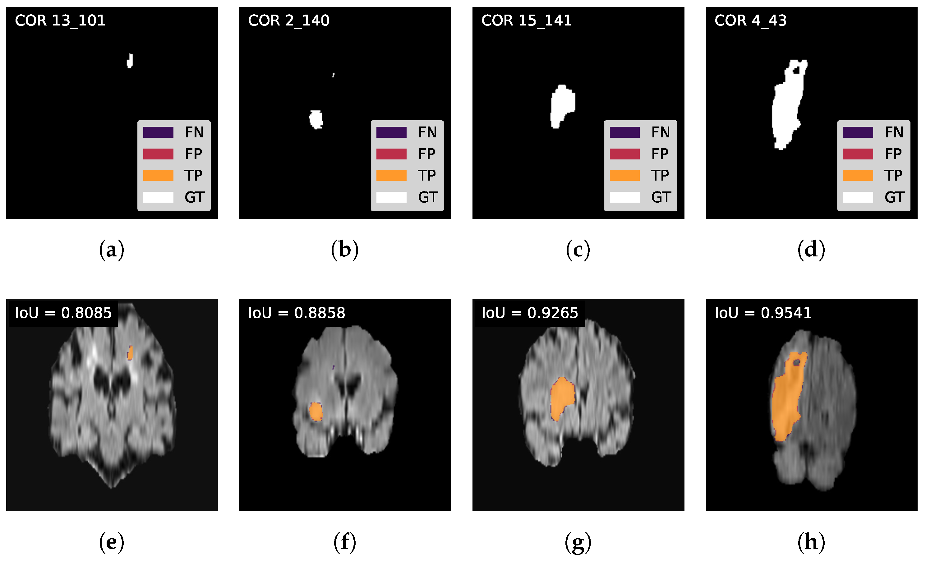 Enhanced Ischemic Stroke Lesion Segmentation in MRI Using Attention U-Net with Generalized Dice ...