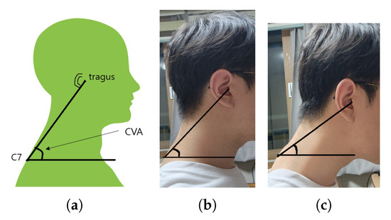 Real-Time Forward Head Posture Detection and Correction System ...