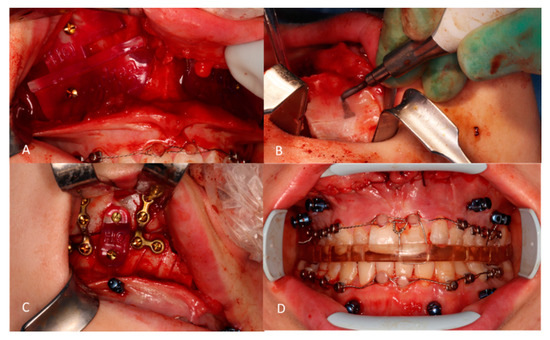 Surgery First and Aligners: A Case Report Combining In-House Surgical ...