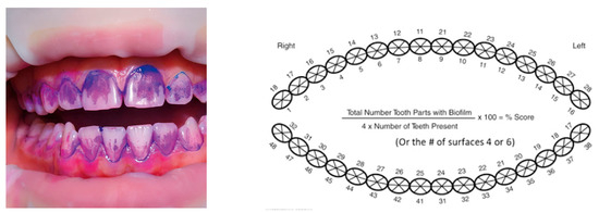 Correlation of Parental and Child Dental Plaque Levels: A Clinical Study