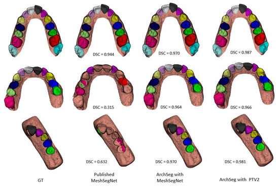 Robust Segmentation of Partial and Imperfect Dental Arches