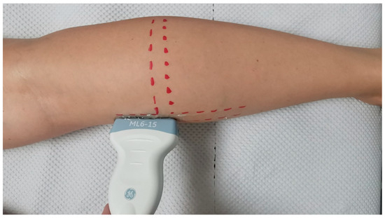A Cross-Sectional Study of Gastrocnemius Medialis Muscle Fascicle ...