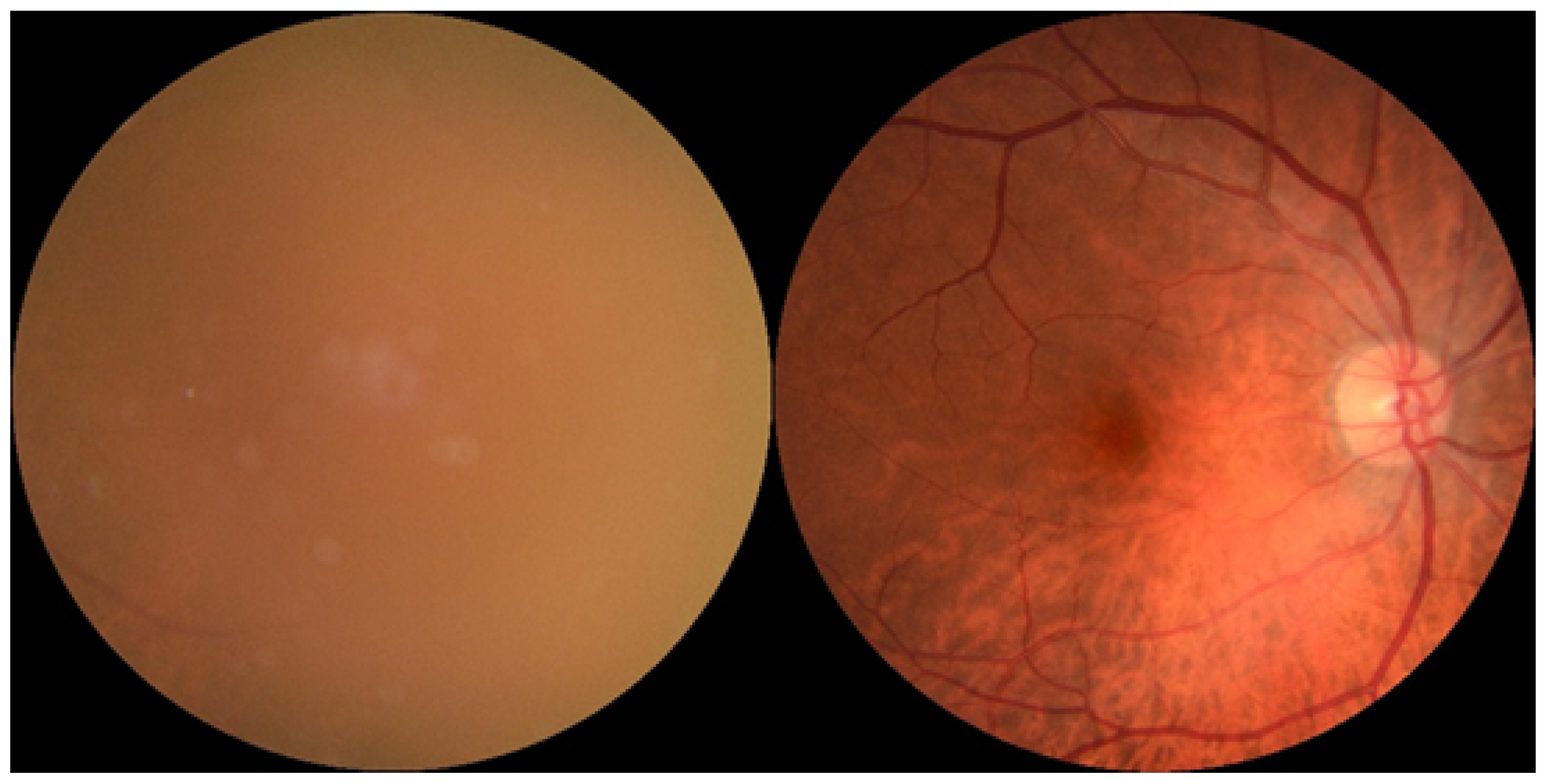 Hybrid Deep Learning Model for Cataract Diagnosis Assistance