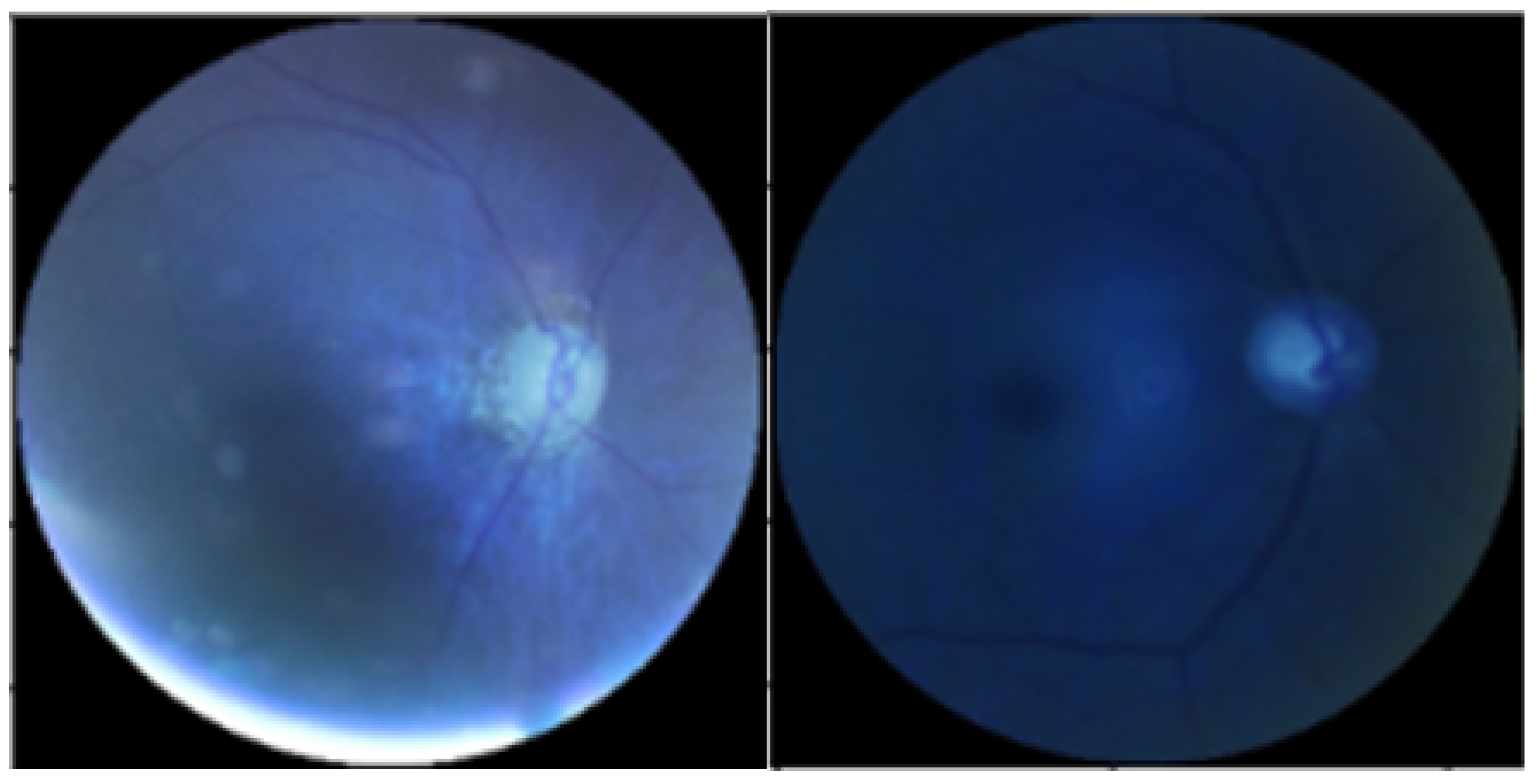 Hybrid Deep Learning Model for Cataract Diagnosis Assistance