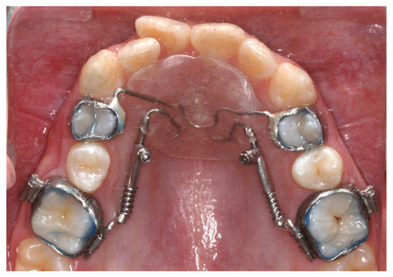 Distalization Methods for Maxillary Molars Utilizing Temporary ...