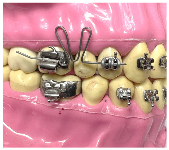 Distalization Methods for Maxillary Molars Utilizing Temporary ...