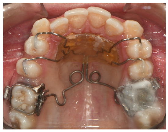Distalization Methods for Maxillary Molars Utilizing Temporary ...